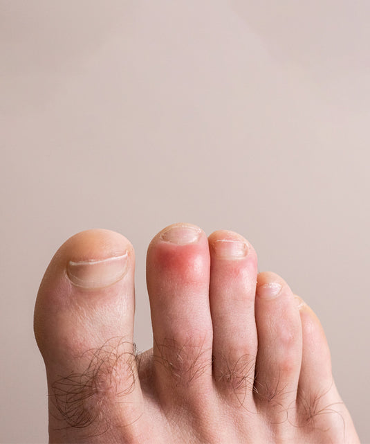 Chilblains – ZeroSole